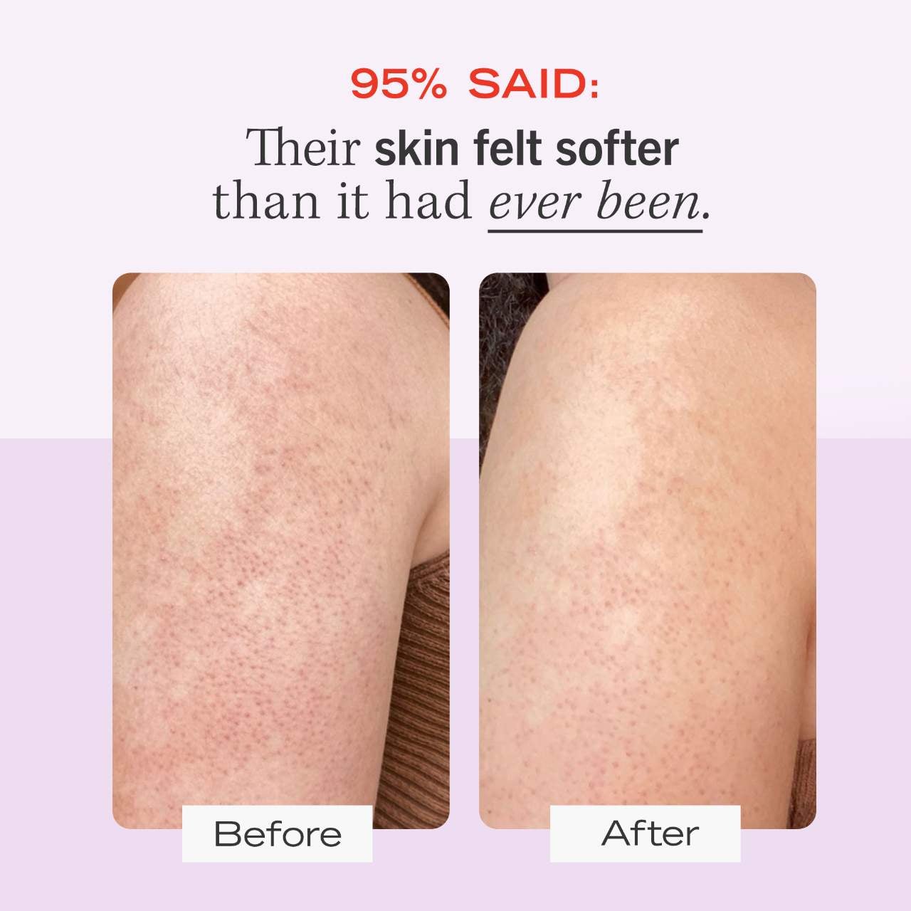 Kp Bump Eraser Body Scrub With 10% Aha – Body Exfoliant For Keratosis ... Kp Bump Eraser Body Scrub With 10% Aha – Body Exfoliant For Keratosis ...
